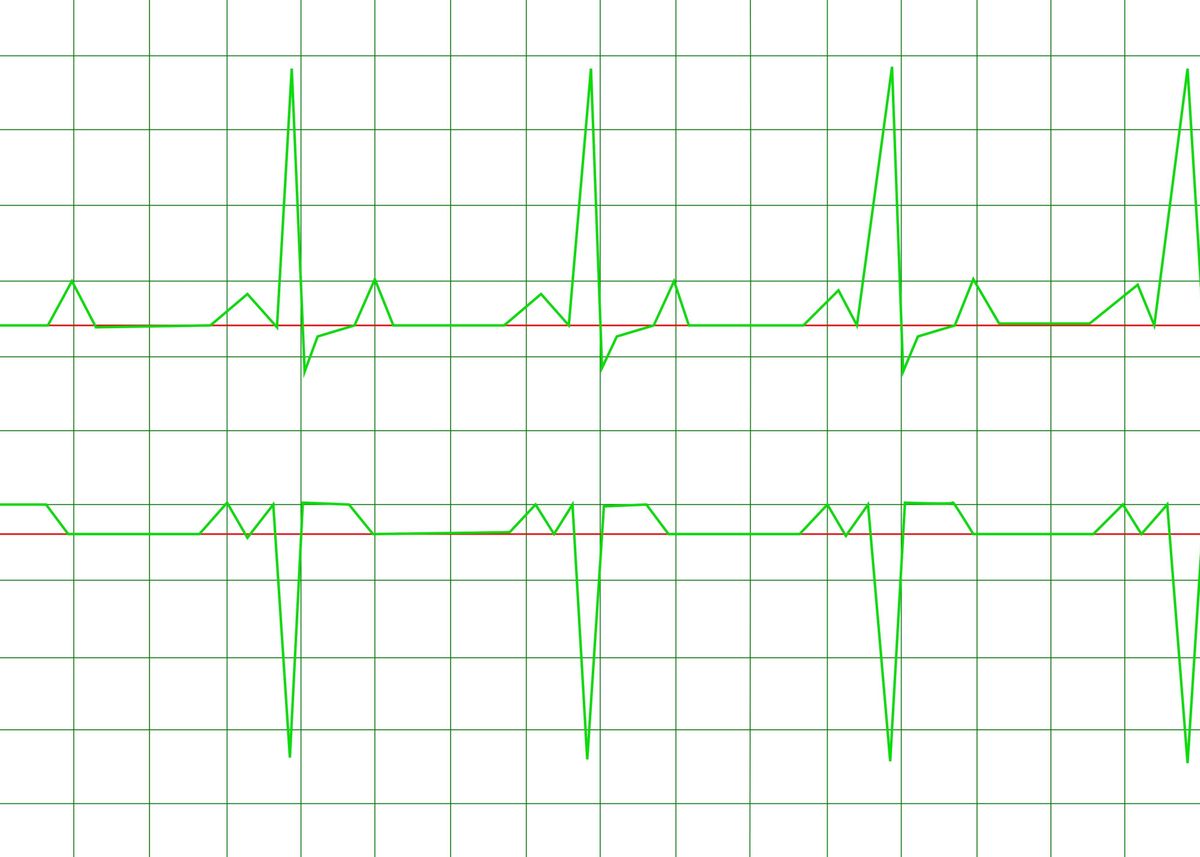 'Normal Heart Rhythm Normal Heart Rhythm electrocardiogr ... ' Poster ...