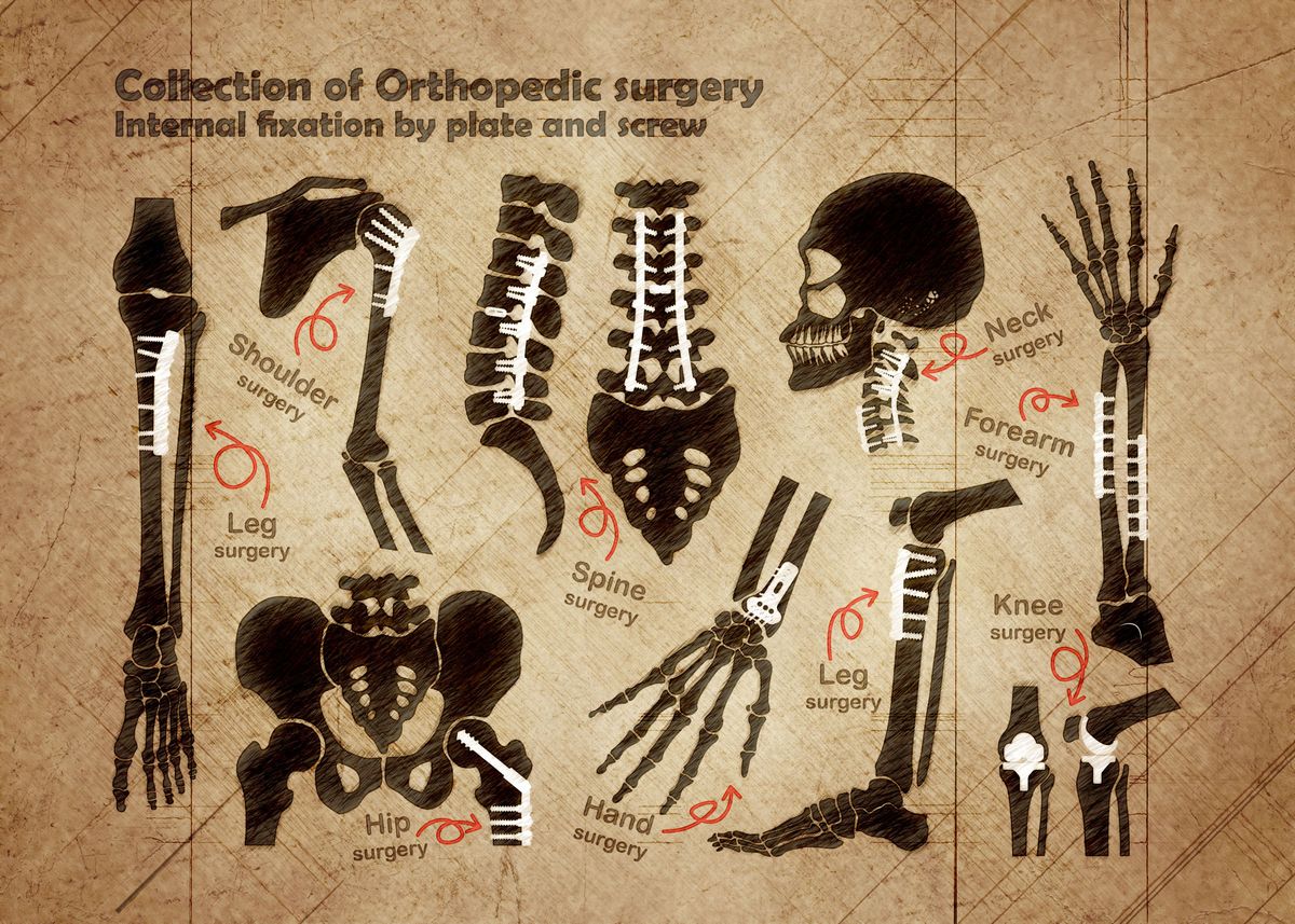 'Orthopedic surgery' Poster, picture, metal print, paint by Luvy | Displate