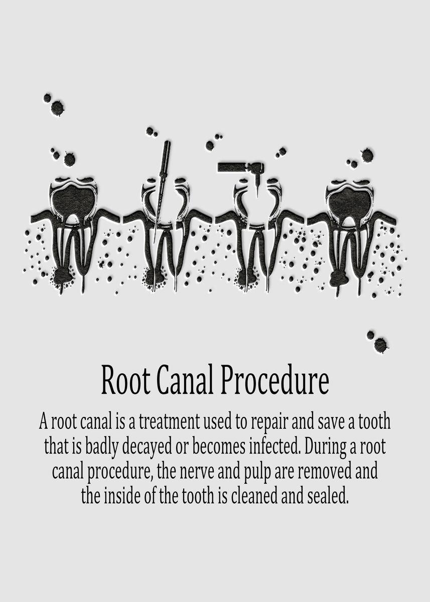 'Root Canal Procedure' Poster by Clayborne Frank | Displate